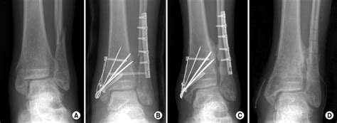 Distal Tibiofibular Synostosis After Syndesmotic Screw Fixation Was Download Scientific Diagram