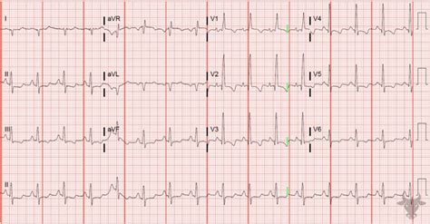 Right Atrial Enlargement Ecg Stampede