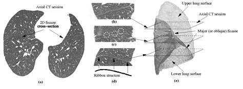Figure 1 From Pulmonary Fissure Segmentation On Ct Semantic Scholar