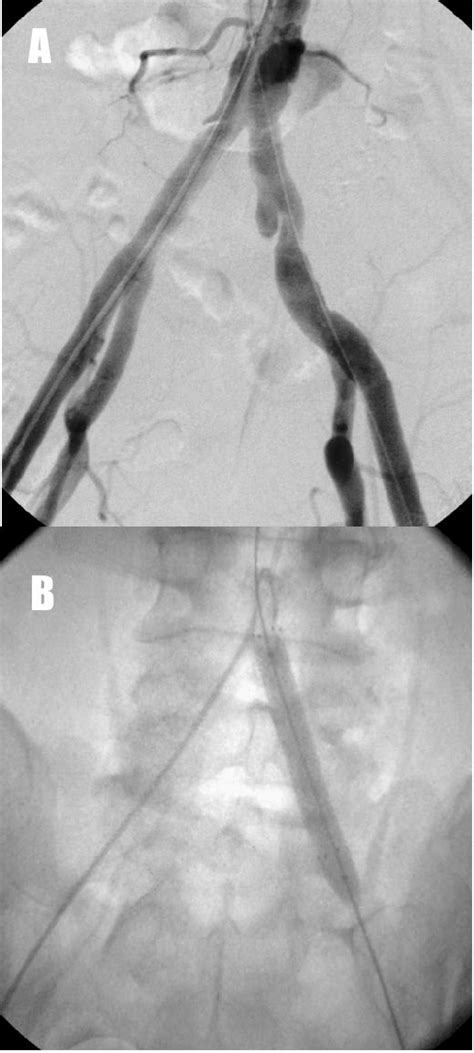 Figure 2 From Acute Onset Of Lower Limb Claudication As A Manifestation Of A Spontaneous Common