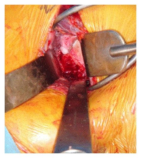 Glenoid Augmentation With Distal Tibial Osteochondral Allograft