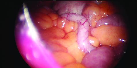 Intra Operative Image Of Appendix Vermiformis Showing Inflamed Appendix Download Scientific