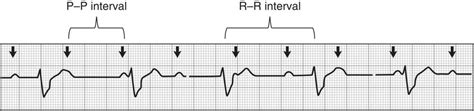 Atrioventricular Conduction Block Anesthesia Key