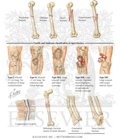 Gustilo And Anderson Classification Of Open Fracture Anatomy And Physiology Open Fracture Pa C