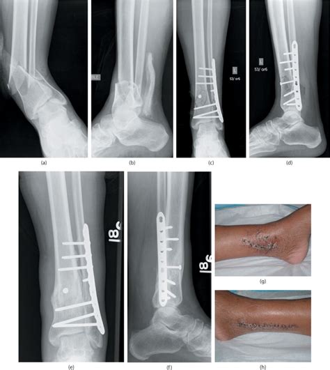 Distal Tibia Fracture Classification