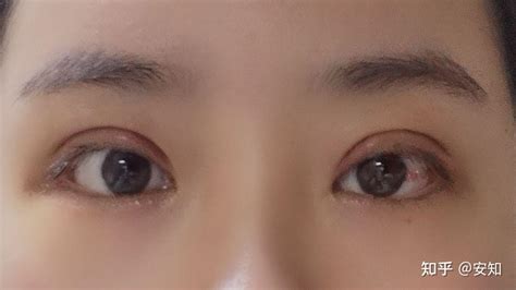 全切双眼皮恢复记录（持续更新） 知乎