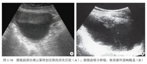 超声微课堂16种常见超声伪像的识别和避免方法灰阶超声篇 搜狐大视野 搜狐新闻