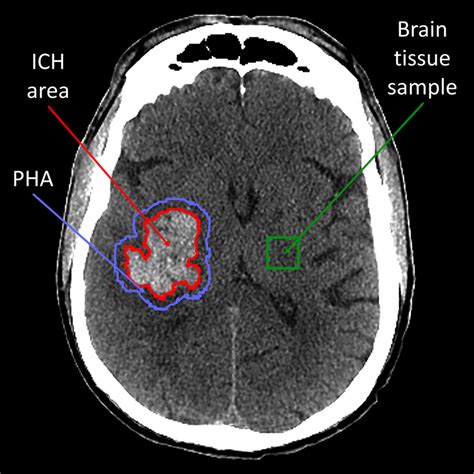 Exemplary Axial Head Ct Image Segmentation Red Contour Intracerebral Download Scientific