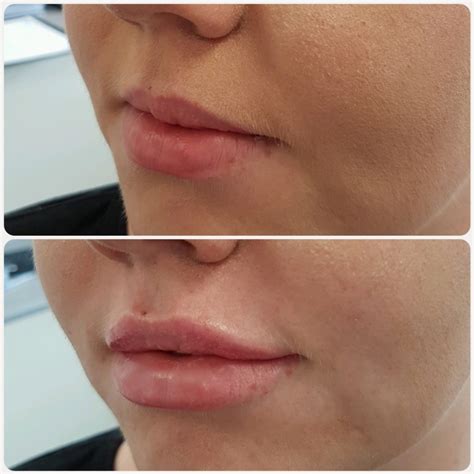 Lip Filler Augmentation Infinity Skin Clinic Leeds