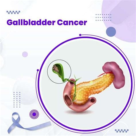 Gallbladder Cancer Signs And Symptoms Uhapo