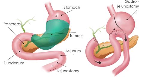 Total Gastrectomy For Stomach Cancer