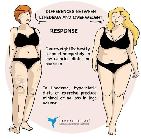 Patient Guide To Self Diagnosing Lipedema And Lipo Lymphedema Artofit