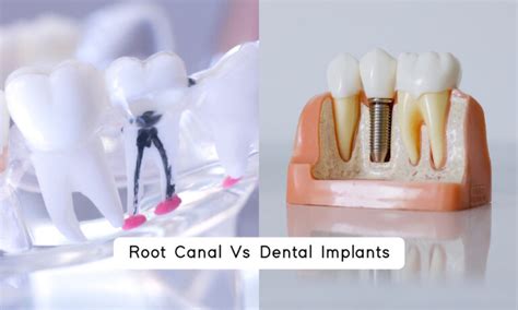 preserving vs replacing root canal or dental implant dant suraksha dental care