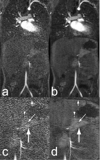 Fast Mri Techniques Body Mri