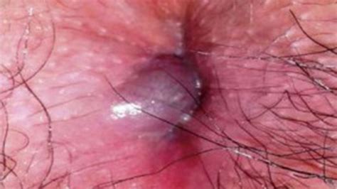 Early Stage Anal Tumor Neuroendocrine Tumor Of The Anal Canal