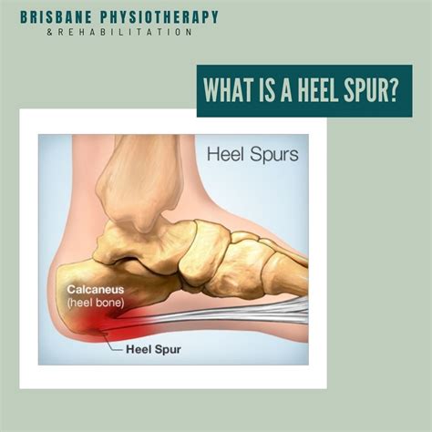 What Is A Heel Spur Brisbane Physiotherapy And Podiatry