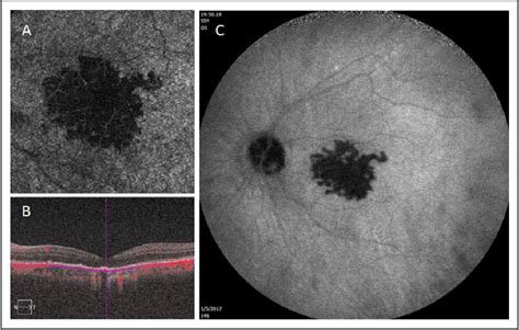 Figure 2 From Persistent Placoid Maculopathy Treatment Response Imaged With Oct Angiography