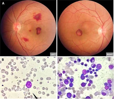 A Strict Vegetarian Diet May Be Harmful Bilateral Macular Bleeding In