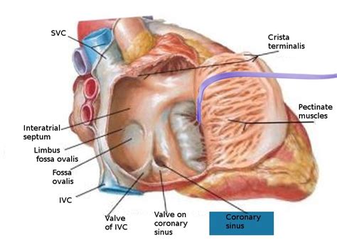 Figure Coronary Sinus Opening Image Courtesy S Bhimji Md
