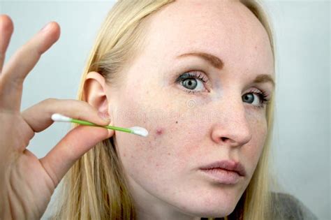 Young Woman With Acne Applying Ointment To The Pimple Beauty Skin Care Lifestyle Concept