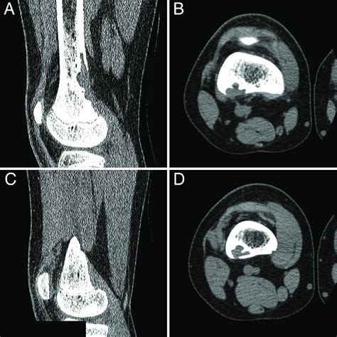 Ossifying Fibroma Tibia