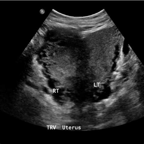 Didelphys Uterus Ultrasound