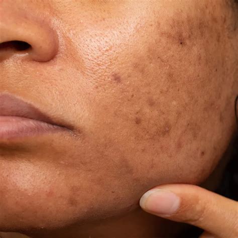 Dark Spots For Mesa Tempe Scottsdale And Queen Creek Az Skin Care