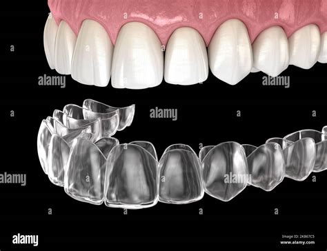 Invisalign Braces Or Invisible Retainer Medically Accurate Dental 3d