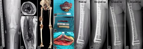 A Patient Undergoing Biological Reconstruction Of Femur Defect With Download Scientific Diagram