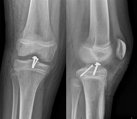 Xray Pictures Of Fractured Tibia Bone And Spine Broken X Ray Image Of