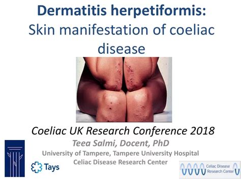 Ppt Dermatitis Herpetiformis Skin Manifestation Of Coeliac Disease