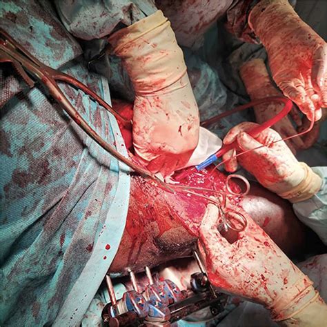 Gluteus Deep Investing Fascia Compartment Block Technique Lra