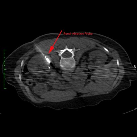 Renal Tumor Ablation Northwest Radiology