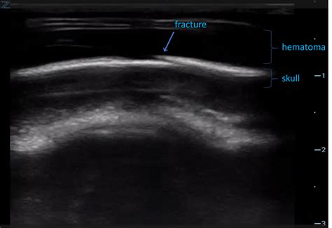 Votw Pediatric Skull Fracture — Maimonides Emergency Medicine Residency