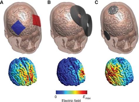 Dorsolateral Prefrontal Cortex Tdcs