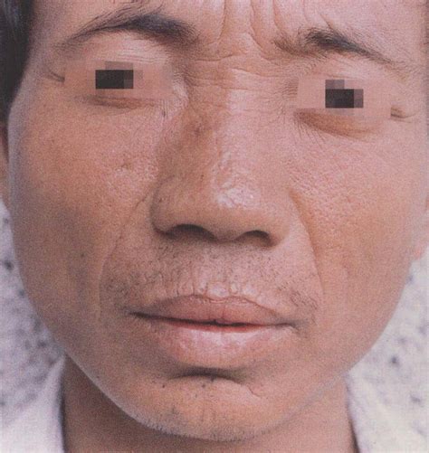 红细胞生成性原卟啉病 临床皮肤病学彩色图谱 医学