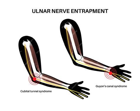 Premium Vector Ulnar Nerve Entrapment