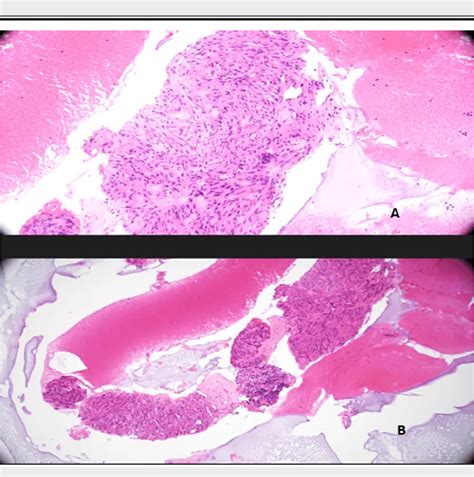Figure 4 From A Case Of Gastrointestinal Stromal Tumour Gist In The