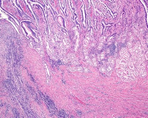 Peptic Ulcer Light Micrograph Stock Image C056 0448 Science