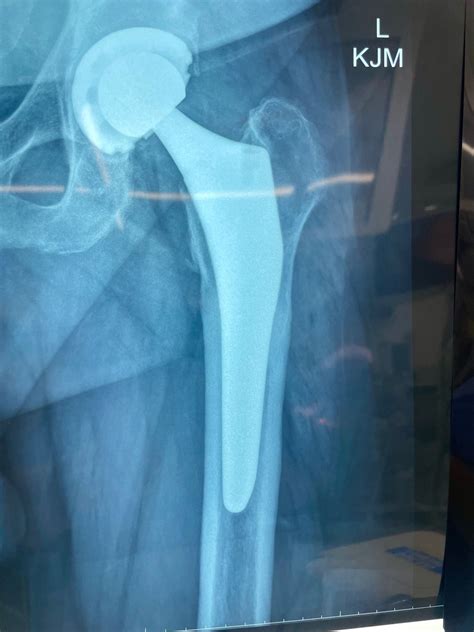 Watson Extraction System On Linkedin Noeto Orthopedics Orthopedicsurgeon Medicaldevice