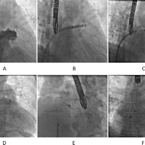 Pdf One Stop Shop” Safety And Efficacy Of Combining Atrial Septal Defect Occlusion And Left