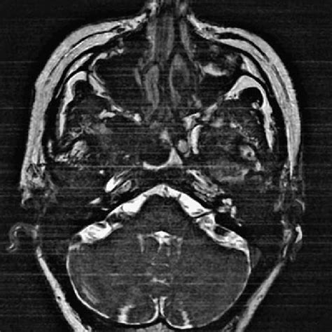 Loop Compression A Loop Of The Aica Involves The Right Viii Cranial Download Scientific