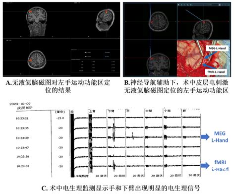 国家重点研发计划取得突破｜全球首例无液氦脑磁图运动功能区定位辅助下的胶质瘤切除手术 脑医汇