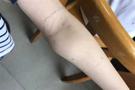 滑膜肉瘤症状图片 有来医生