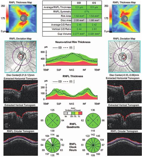 Optic Nerve Eye Glaucoma At Ronald Alvarez Blog
