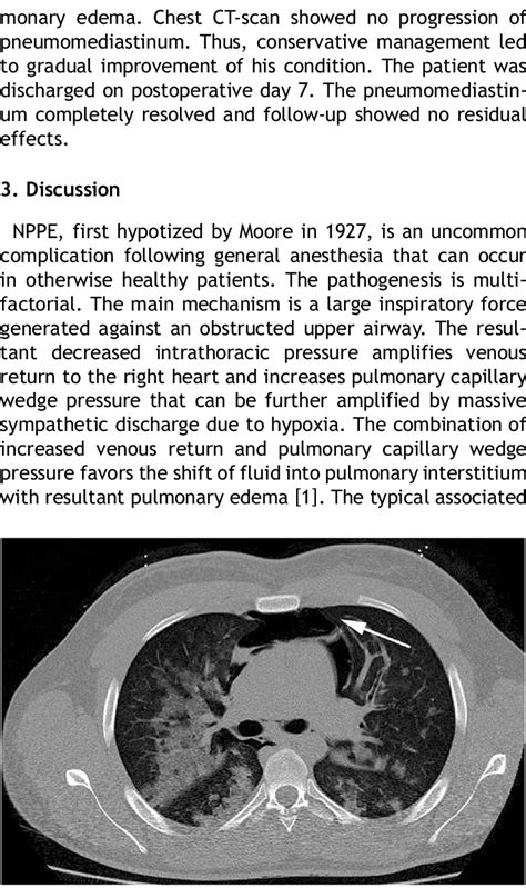 Chest Ct Scan Shows Bilateral Diffuse Pulmonary Infiltrates And The Download Scientific Diagram