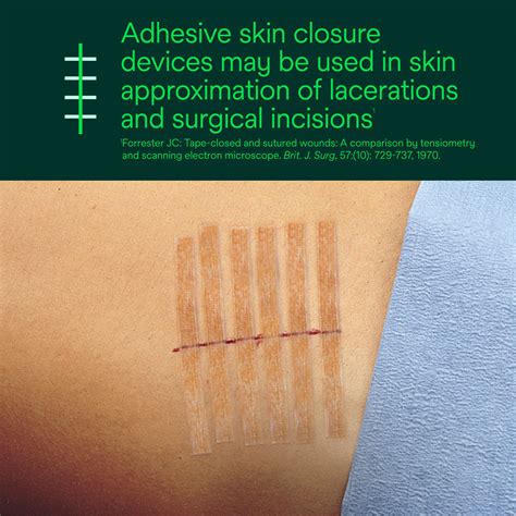 3m™ Steri Strip™ Reinforced Adhesive Skin Closures R1542sb Sterile