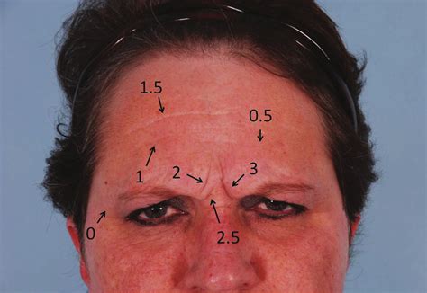 Modified Fitzpatrick Wrinkle Grading Scale Grade 0 Absence Of