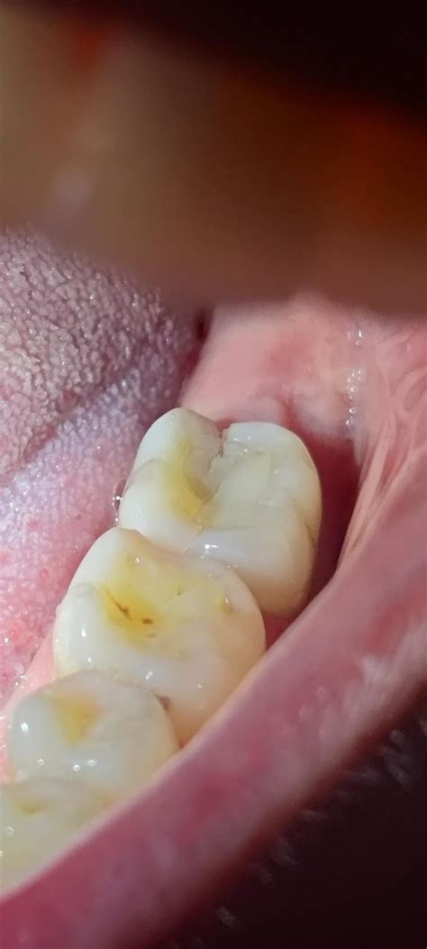 Tooth Split In Half Raskdentists