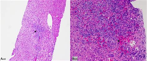 Fibrosing Cholestatic Hepatitis Masquerading Acute Rejection Acg Case Reports Journal